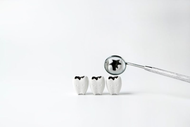 Carie dentaire : évolution et complications possibles | M Dentistes